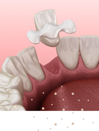 Crown / Bridges / Bio-temp / Build up - A Briter Smile