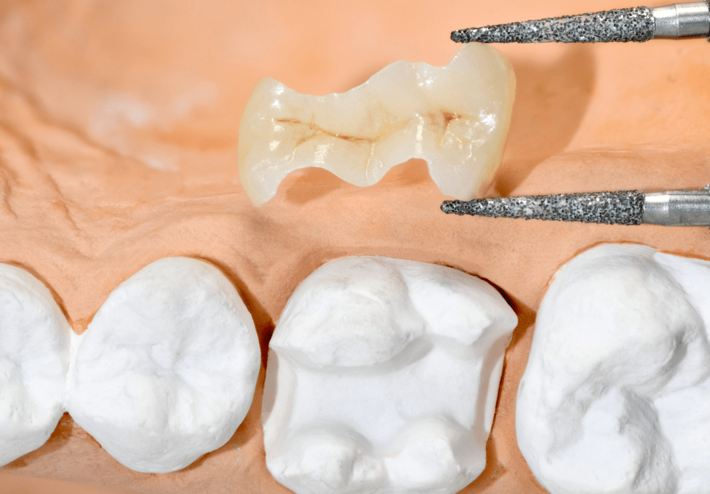 Family Dentistry Los Angeles | Inlay / Onlay